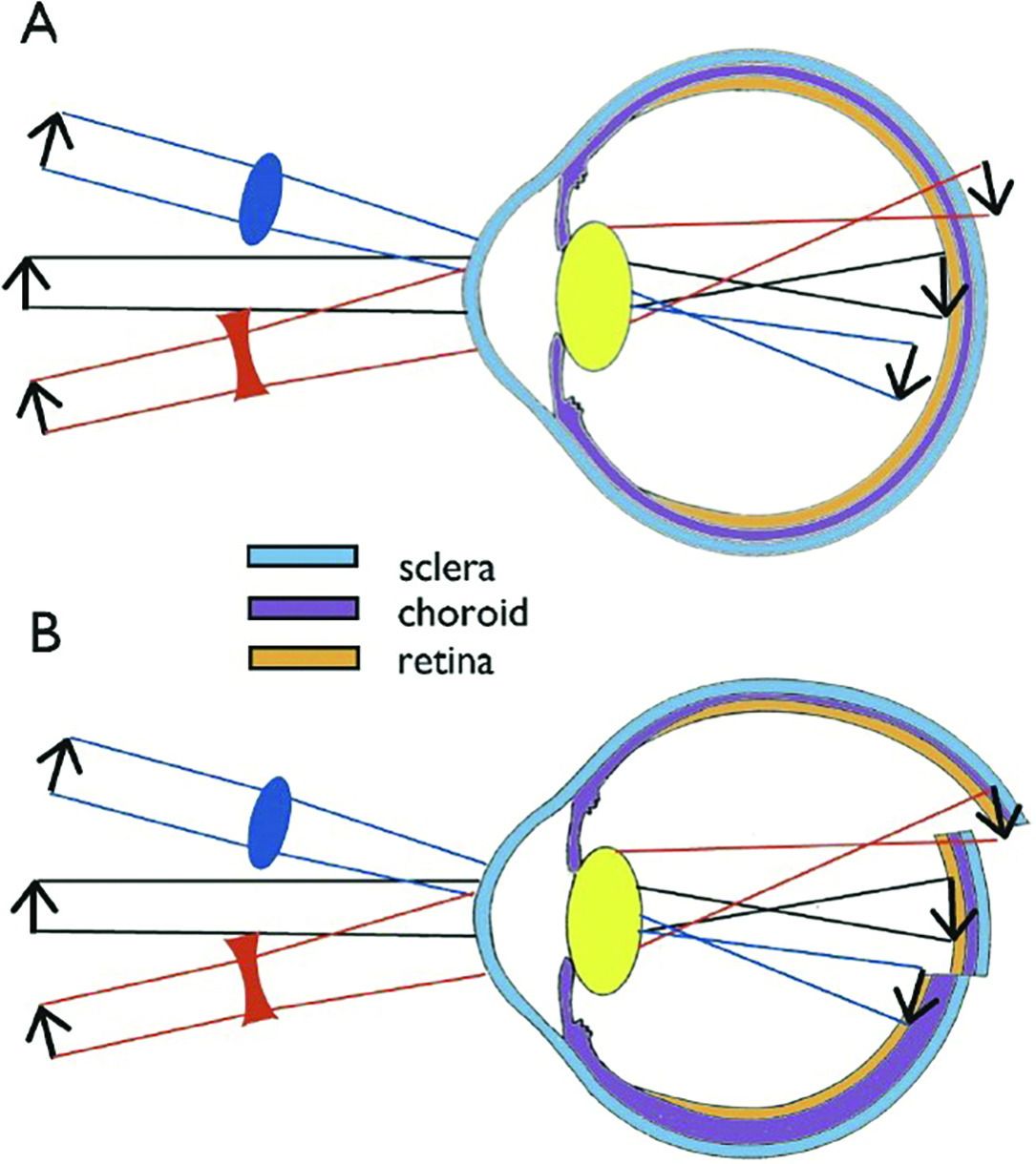 Defocus Incorporated Multiple Segments (DIMS) Spectacle Lens for Myopia ...