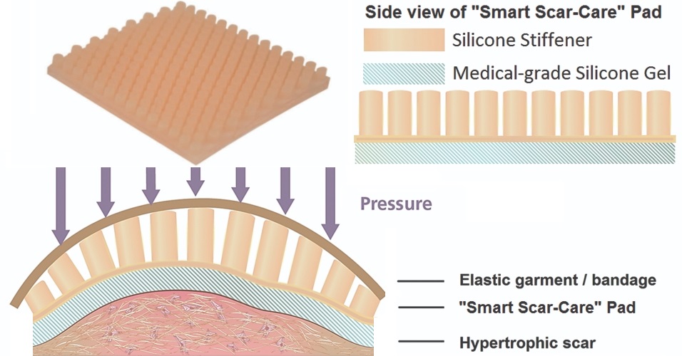 “Smart Scar-Care” Pad: for a “Scar-less” World | Knowledge Transfer and ...