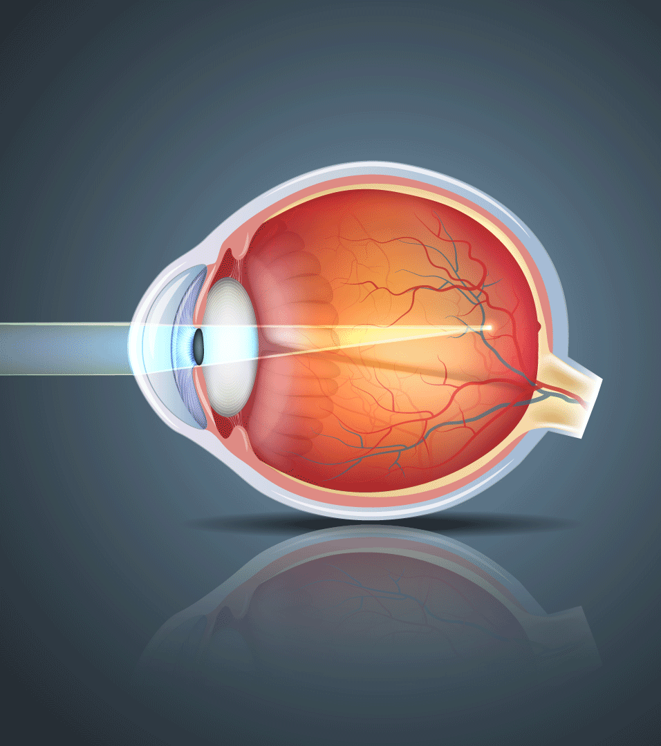 Centre for Myopia Research | School of Optometry